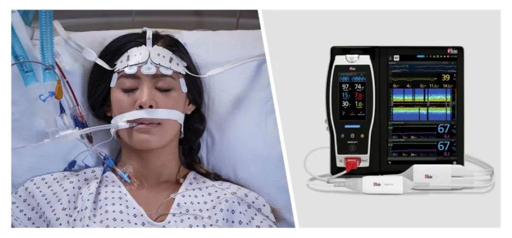Monitor cerebral: o que você precisa saber?